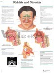 Rhinitis And Sinusitis - Anatomical Chart at Best Price in Ambala Cantt ...