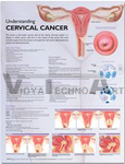 Understanding Cervical Cancer Anatomical Chart at Best Price in Ambala ...