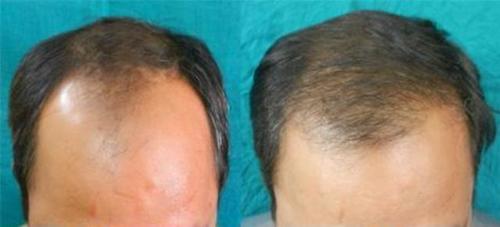 Hair Weaving And Bonding at Best Price in New Delhi | Fusion Hair ...