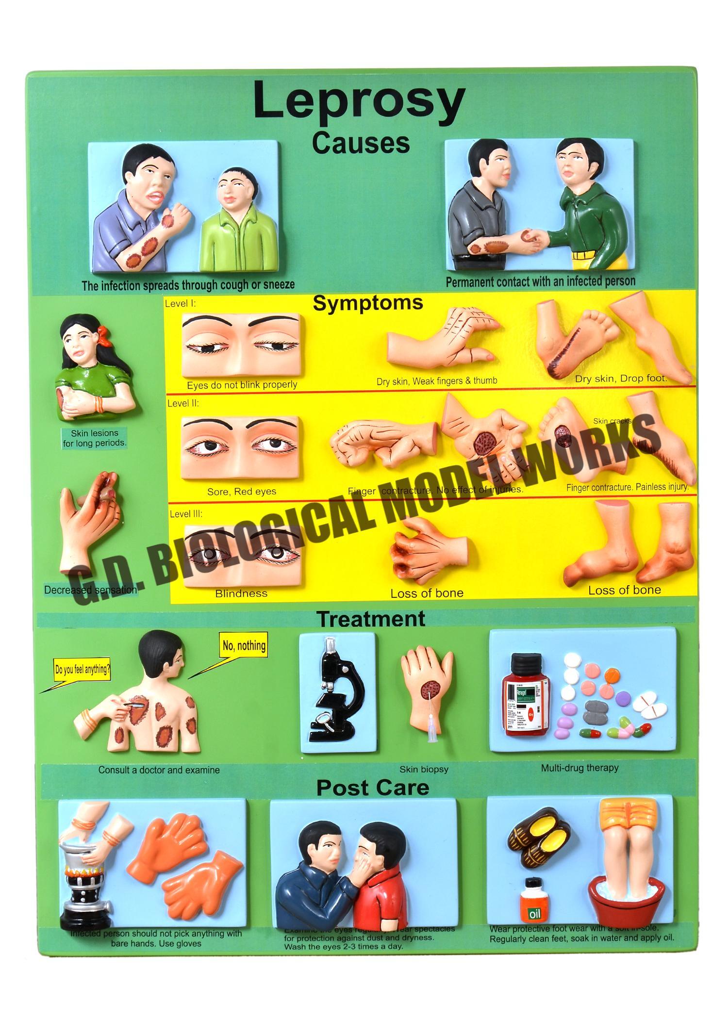 Leprosy Model - Color: Natural at Best Price in Ambala Cantt | G. D ...