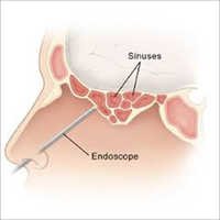 Endoscopic Sinus Surgery at Best Price in Delhi, Delhi | Indian Blessings